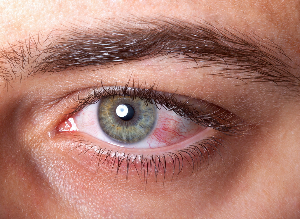 How To Prevent Dry Eyes With Contacts LensDirect